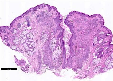 Pathology Outlines Nevi General