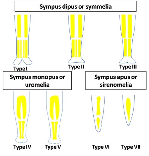 Stocker And Heifetz Classification Of Sirenomelia Into Seven Types