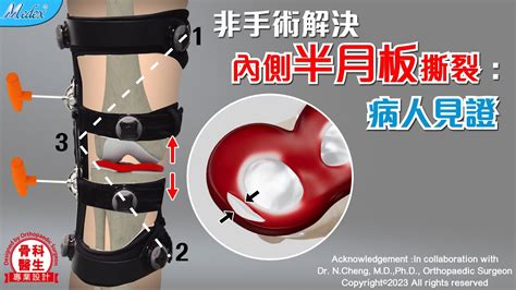 非手術解決內側半月板撕裂之病人見證 K39d 3D Animation YouTube