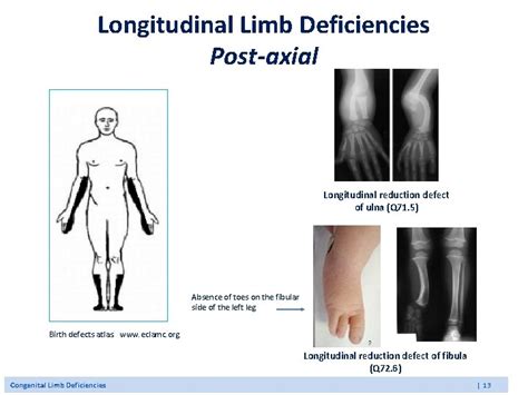 Congenital Limb Deficiencies Limb Reduction Defects Presenter Learning