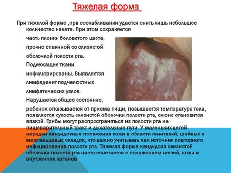 Кандидоз полости рта у детей презентация онлайн