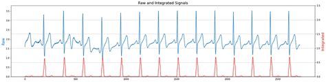 Icd Sensing And Detection Algorithms By Nicole Chiou Medical Cps Medium