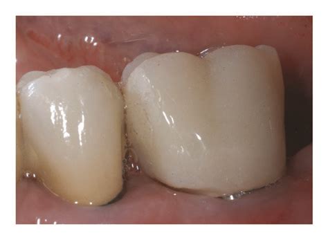 Control Group Analog Workflow A Radiograph Of The Failing Tooth