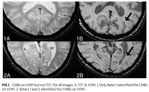 Swi Or T2 Which Is Better To Detect Cerebral Microbleeds