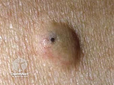 Cutaneous Cysts And Pseudocysts