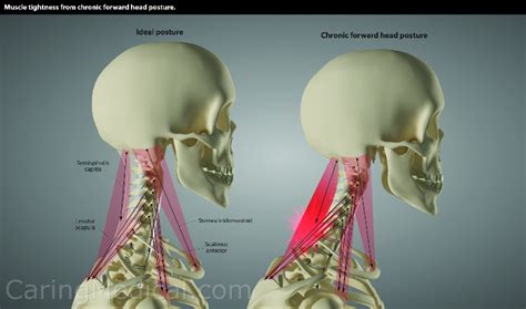 Forward Head Posture