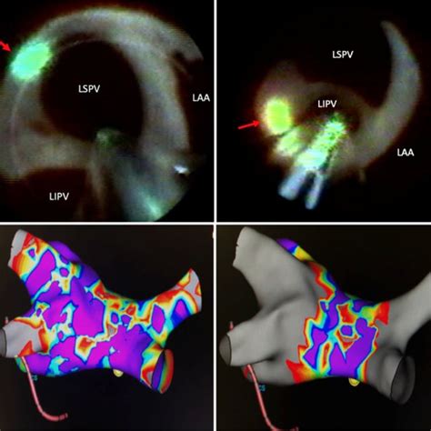 Pdf Clinical Applications Of Laser Technology Laser Balloon Ablation