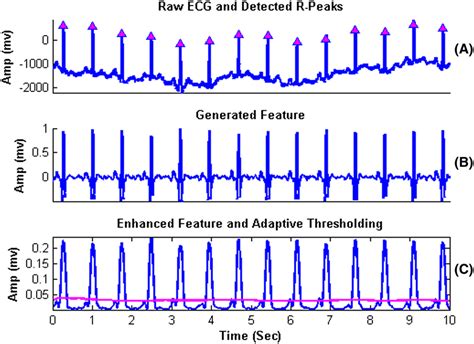 R‐peak Detection Of Ecg Signal Record‐s0020are Of The Ptbdb A Ecg