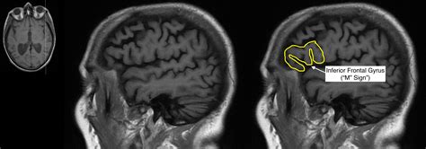 Inferior Frontal Gyrus Mri