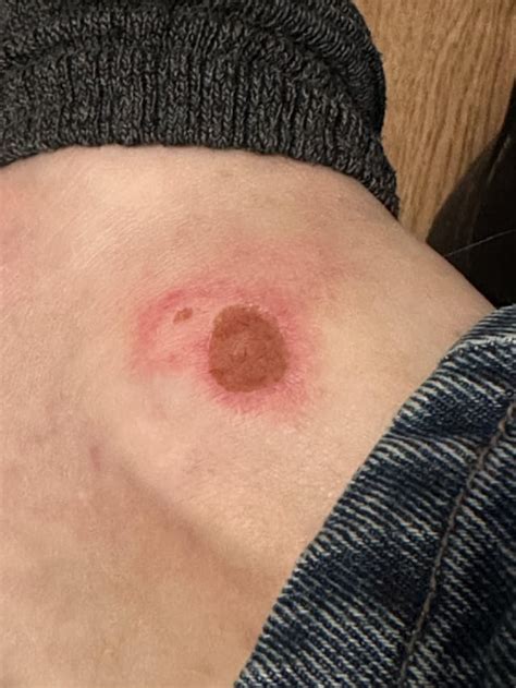 Skin Abnormality On Ankle Does Anyone Know What This Is Rmedical