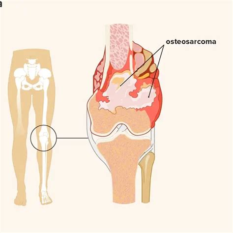 Osteosarcoma Test Price In Delhi Cost Near Me India Ganesh Diagnostic