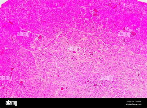 Human Pancreas With Diabetes Mellitus Type 1 Showing Acin And Islets Of Langerhans Optical