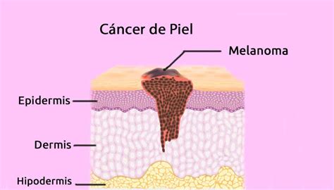 Cáncer De Piel Todo Lo Que Debes Saber Mejor Con Salud