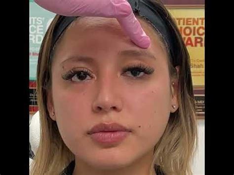 Treating Ptosis With Botox Botox Brow Lift Eyebrow Lift Botox Botox