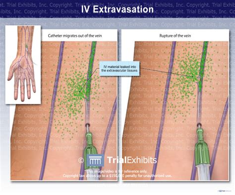 Extravasation Diagram