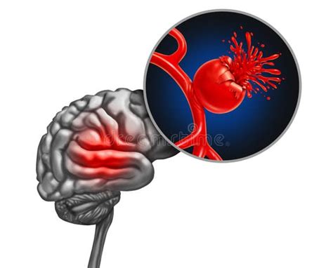 Ruptured Brain Aneurysm Stock Illustration Illustration Of Arterial