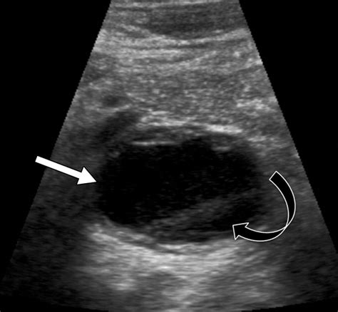 Pheochromocytoma The Range Of Appearances On Ultrasound Ct Mri And
