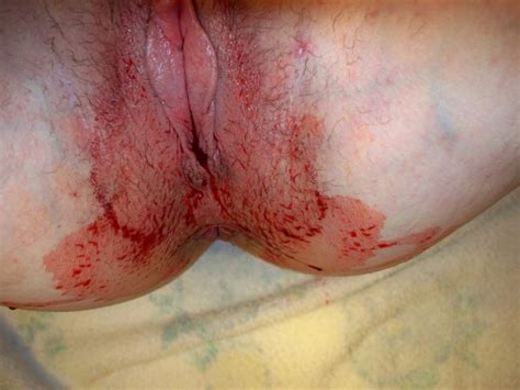 Woman Pussy Bleeding