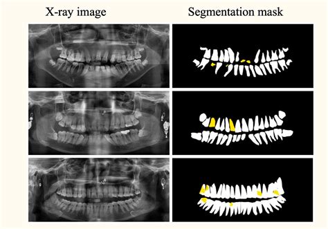 🦷 automating dental caries detection with deep learning a u net based