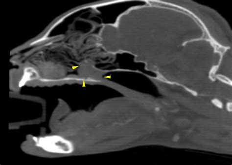 Ct Inflammatory Nasopharyngeal Polyp Secondary To Rhinitis Causing