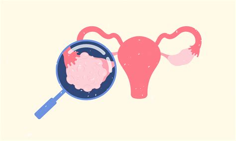 Health Spotlight Understanding Ovarian Cancer — Skye Wealth