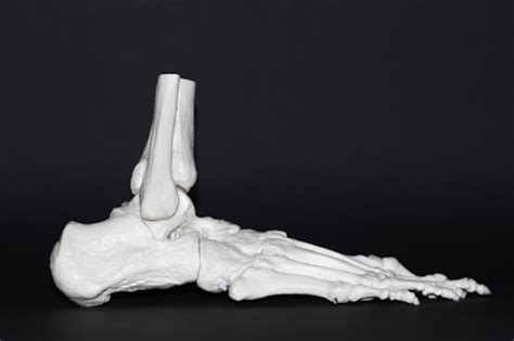 Pars Interarticularis Fracture A Radiological Review