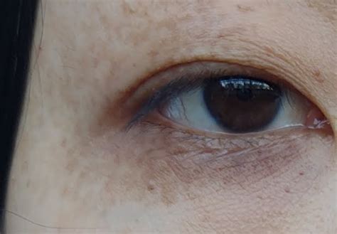 Help With Hyperpigmentation Around Eye R30plusskincare