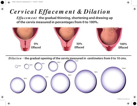 Cervical Effacement And Dilation Chart