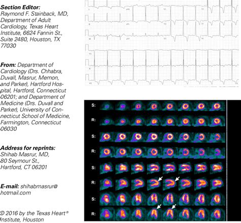 Figure 1 From Spect Myocardial Perfusion Imaging In The Diagnosis Of Apical Hypertrophic
