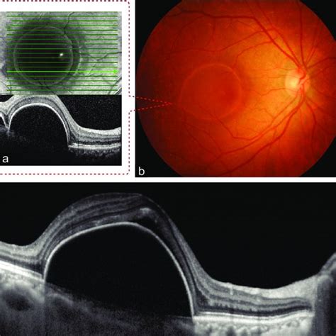 Multimodal Imaging Of The Right Eye At The First Presentation A Download Scientific Diagram