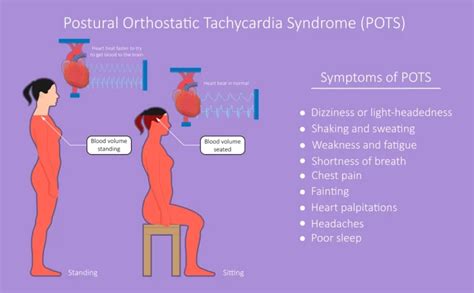Pots Syndrome Diagnosis And Care Dr Cynthias Holistic Approach