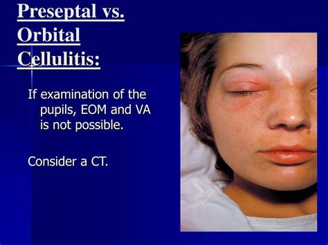 Ppt Posterior Blepharitis Powerpoint Presentation Free Download Id 3336265