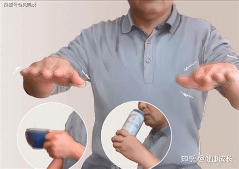特发性震颤会并发哪些疾病并发症有哪些 知乎
