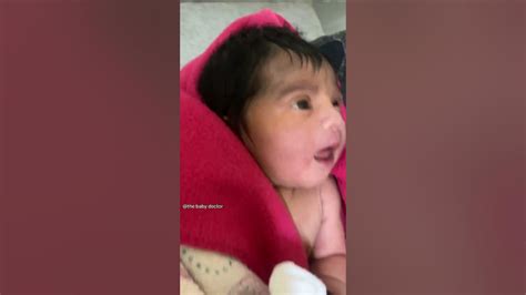 Newborn Causes Of Macroglossia In Newborn Newborn Shorts