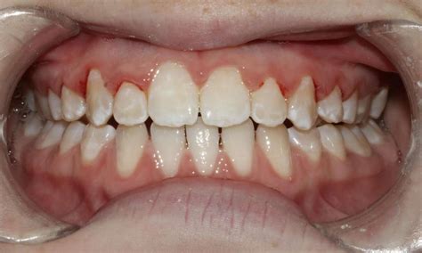 Braces On Upper Teeth Smile Gallery Images Mona Vale Nsw
