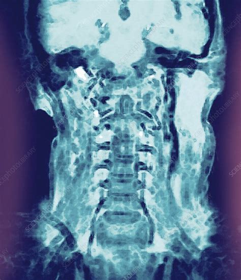 Normal Head And Neck Mri Scan Stock Image F001 3011 Science Photo Library