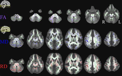 Whole Brain Tract Based Spatial Statistics Results Top Fractional