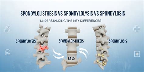 The Impact Of Prosthetics In Sports And Athletics