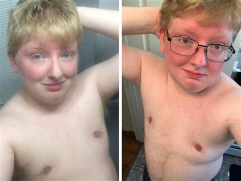 Ftm Chest Surgery Medicare At Sara Swasey Blog