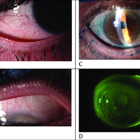 Ocular Surface Photos Demonstrating Inflammation Related To Ded A Download Scientific Diagram
