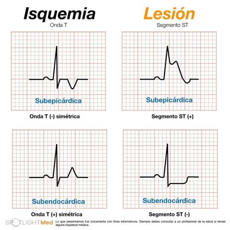 Isquemia Subepicárdica E Grave Retoedu