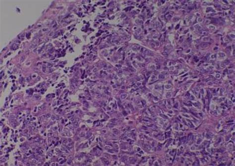 Novus Biologicals Human Ovary Tissue Microarray Cancer Human Ovary