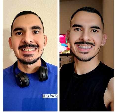 If Youre Thinking About Getting Braces As An Adult Heres Your Sign To Do It 😁 4 Months In