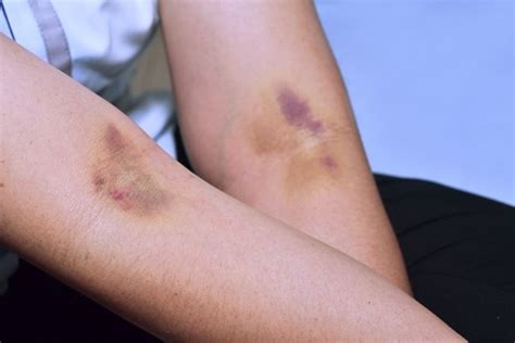 Purpura Kenali Penyebab Gejala Dan Pengobatannya Alodokter