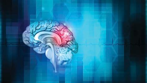 Acv Y Tratamiento Se Cuadruplicó El Tiempo De La Ventana Terapéutica Para Tratar El Accidente