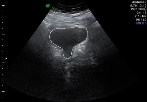 Radiopaedia Case Cystocele Transabdominal Ultrasound Id 60178 Study Radiopaedia Case Cystocele Transabdominal Ultrasound Id 60178 Study