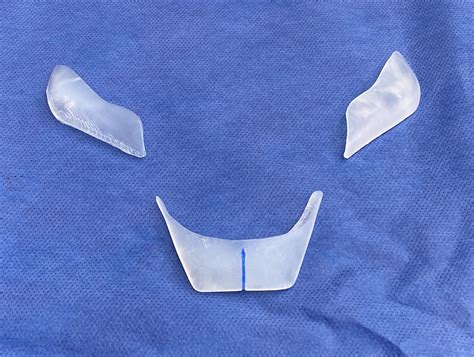 Custom Square Chin And Jaw Angle Implants Intraop Dr Barry Eppley