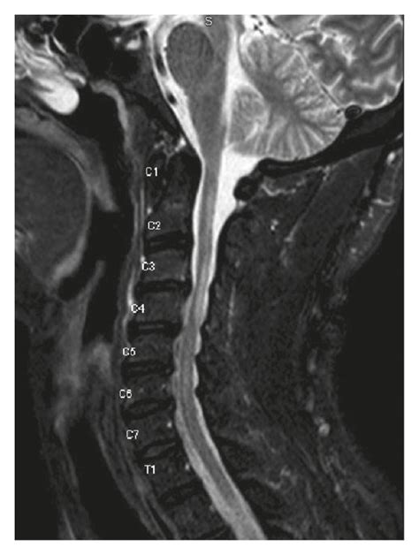Hyperintense Lesions Representing Demyelination From C2 To C6 On Mri