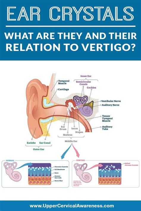 Ear Crystals What Are They And Their Relation To Vertigo Upper