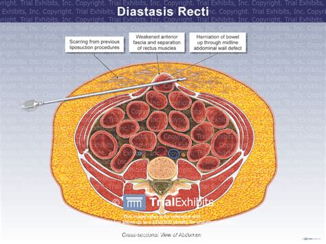 Diastasis Recti Trialquest Inc